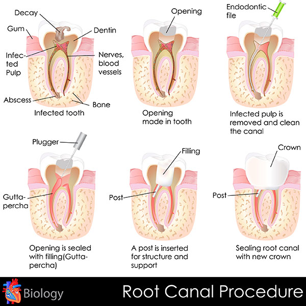 What Is A Root Canal Treatment Media Center Dental Burbank California