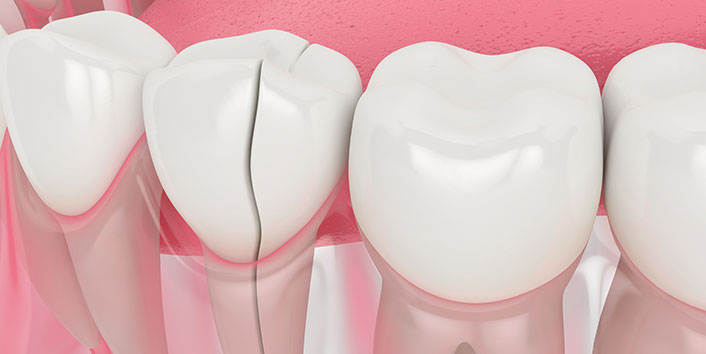 Types of Dental Root Fractures Burbank, CA | Media Center Dental | Root ...